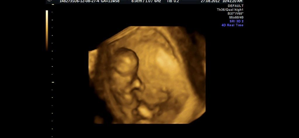 Gender guesses? 11w5d | BabyCentre